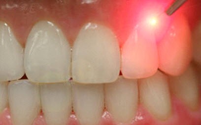 Soft Tissue Laser Vaughn Family Dental
